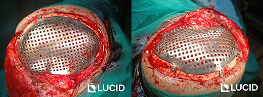 Titanium Implants | LUCID Implants